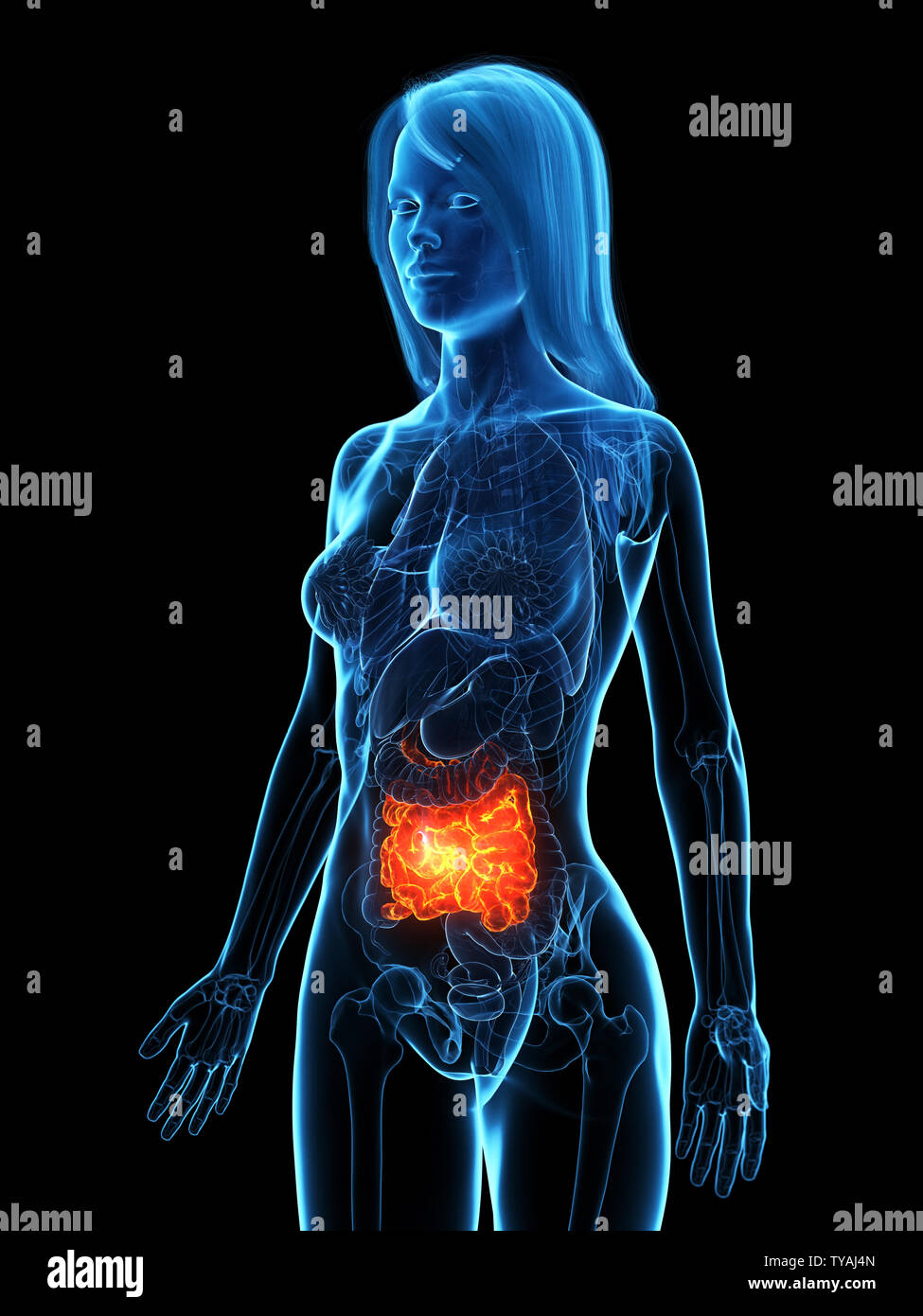 3d rendered medically accurate illustration of a diseases small ...