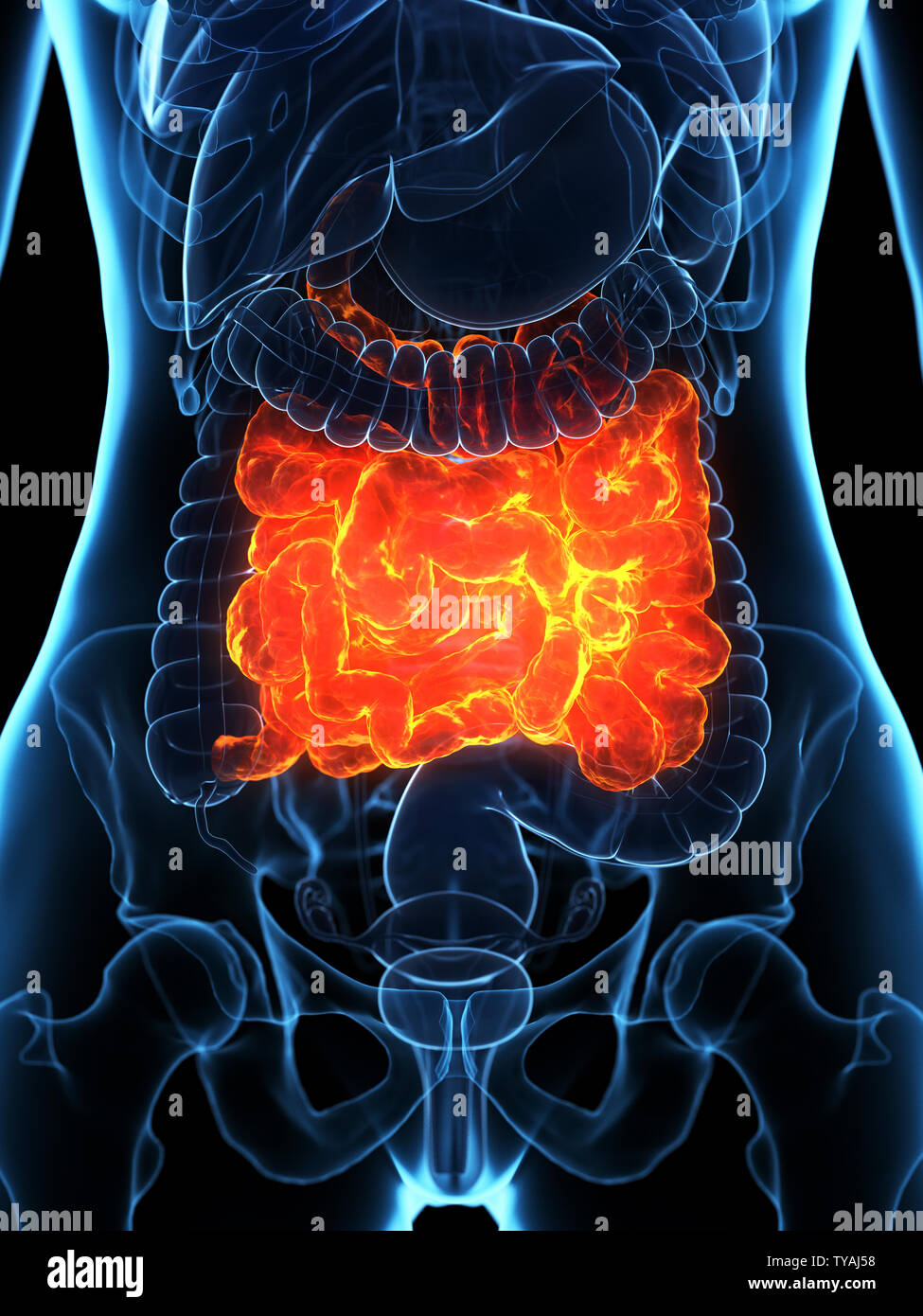 3d rendered medically accurate illustration of a diseases small ...