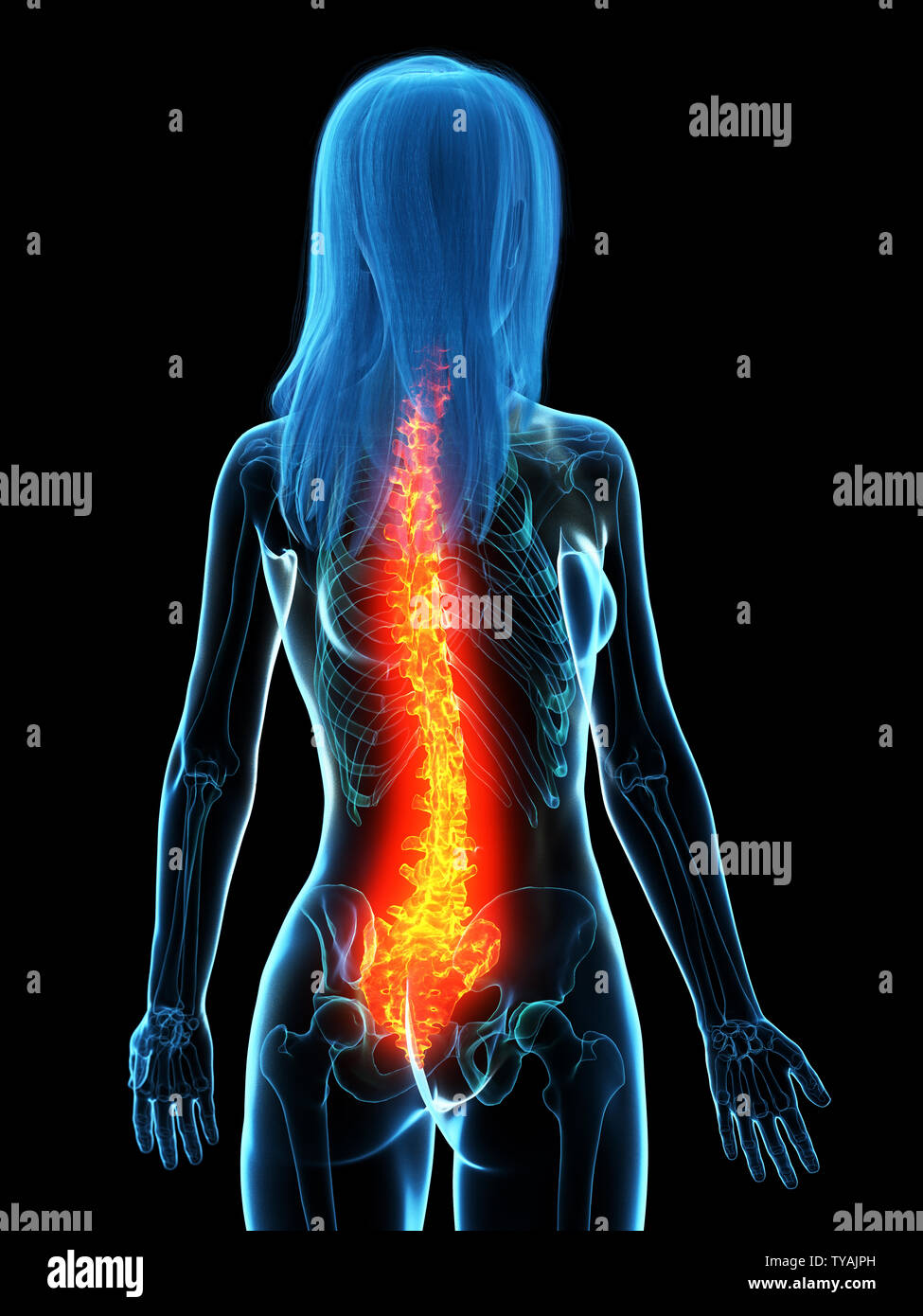3d rendered medically accurate illustration of a painful spine Stock ...