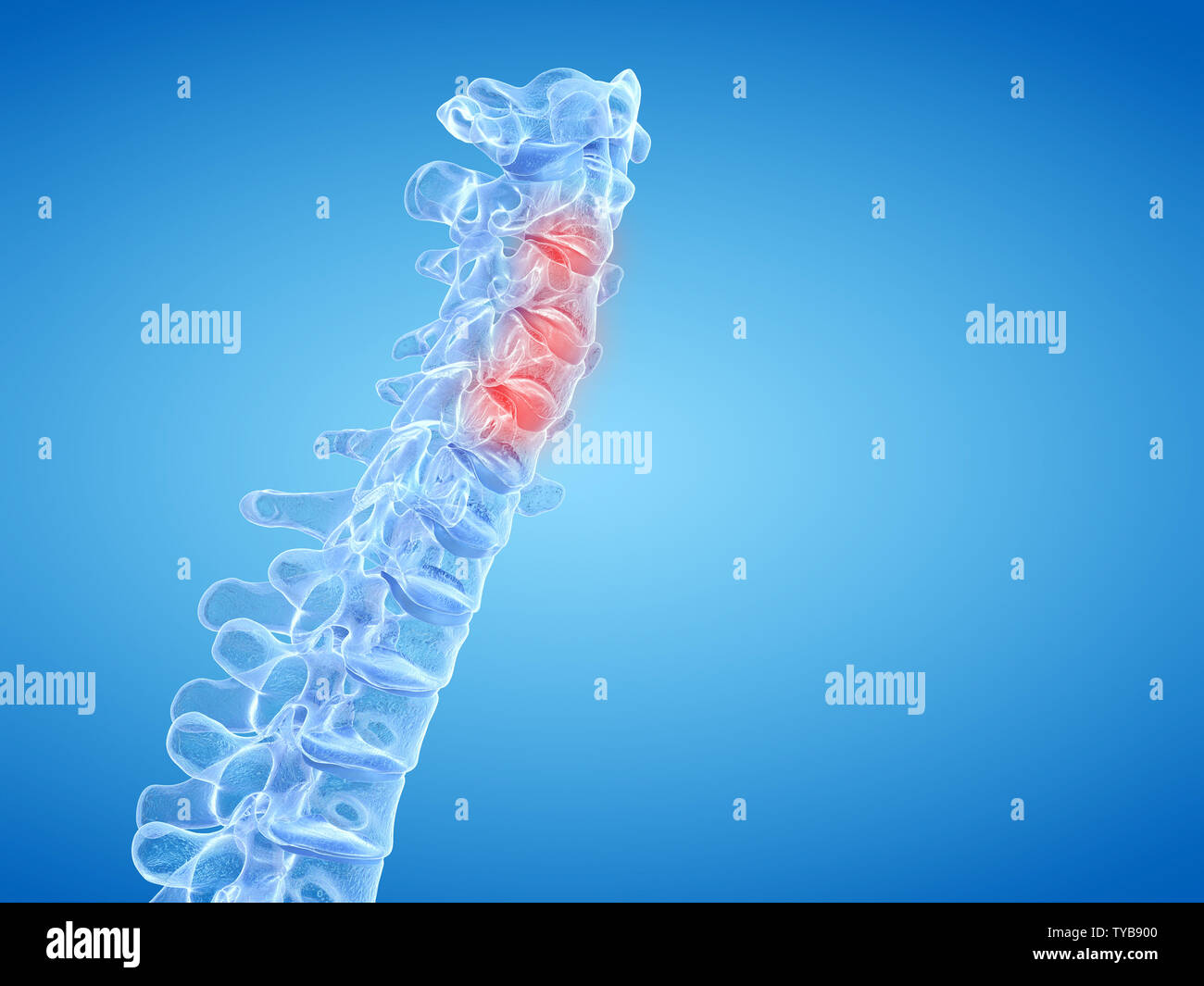 Intervertebral hernia hi-res stock photography and images - Alamy