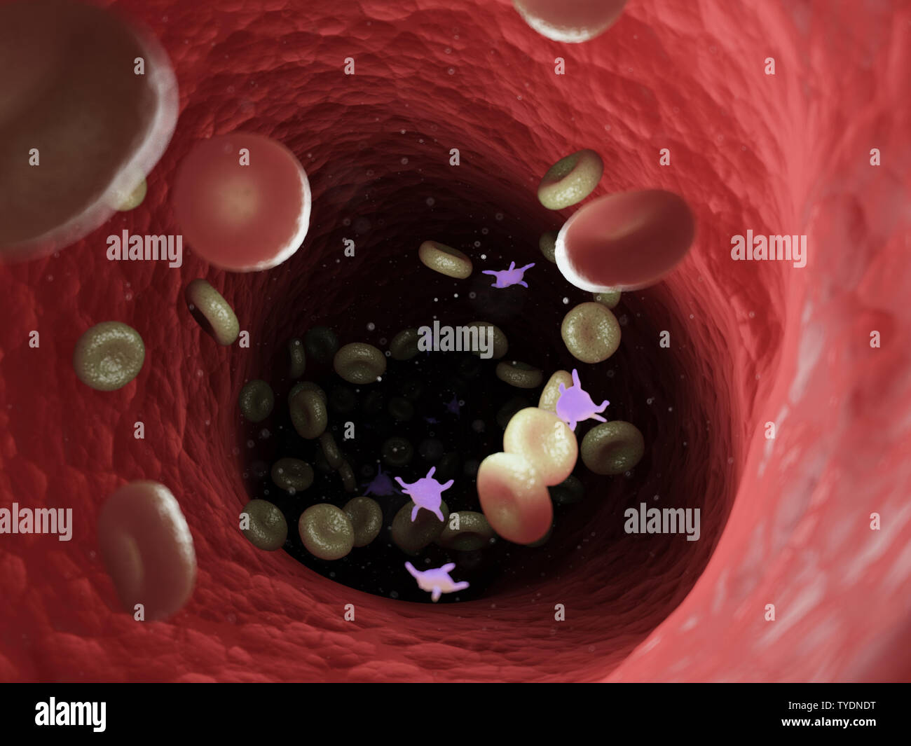 3d rendered medically accurate illustration of diseased blood cells ...