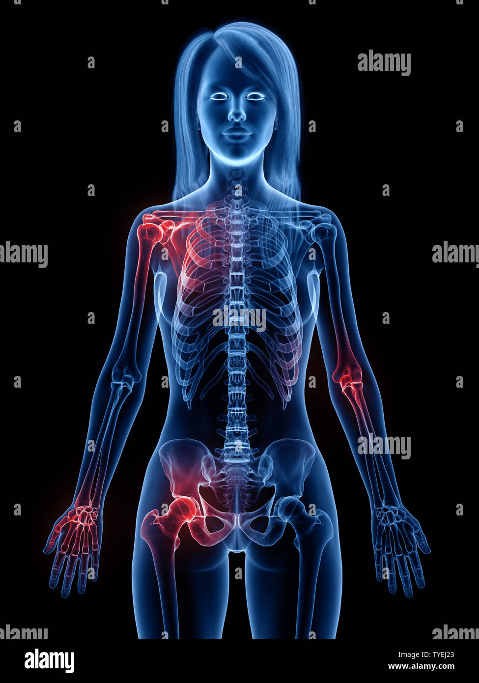 3d rendered medically accurate illustration of painful joints Stock ...