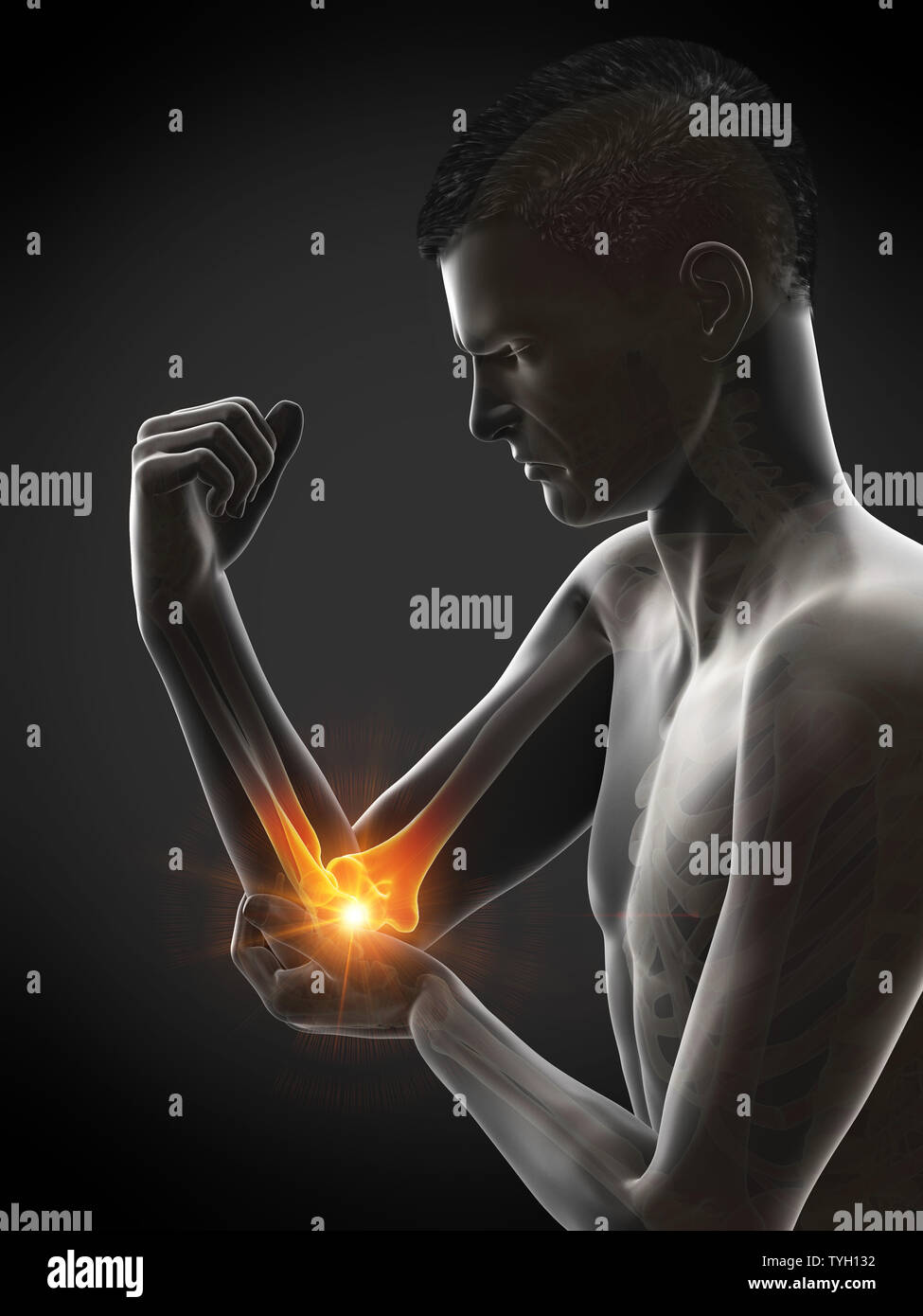 3d rendered medically accurate illustration of a man with painful elbow ...
