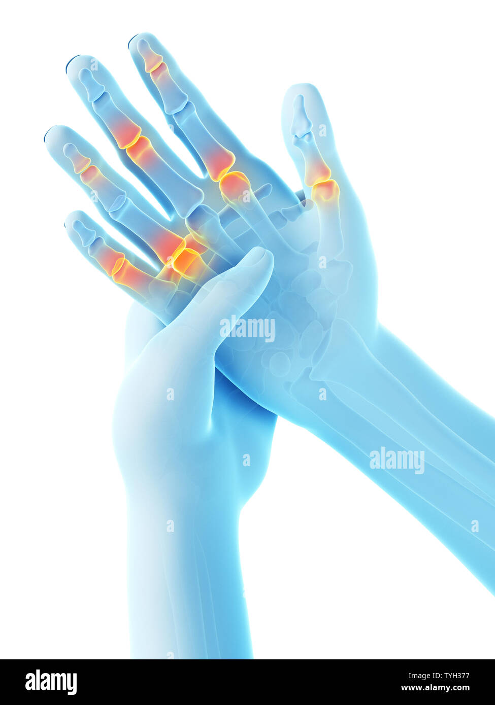 3d rendered medically accurate illustration of painful finger joints ...