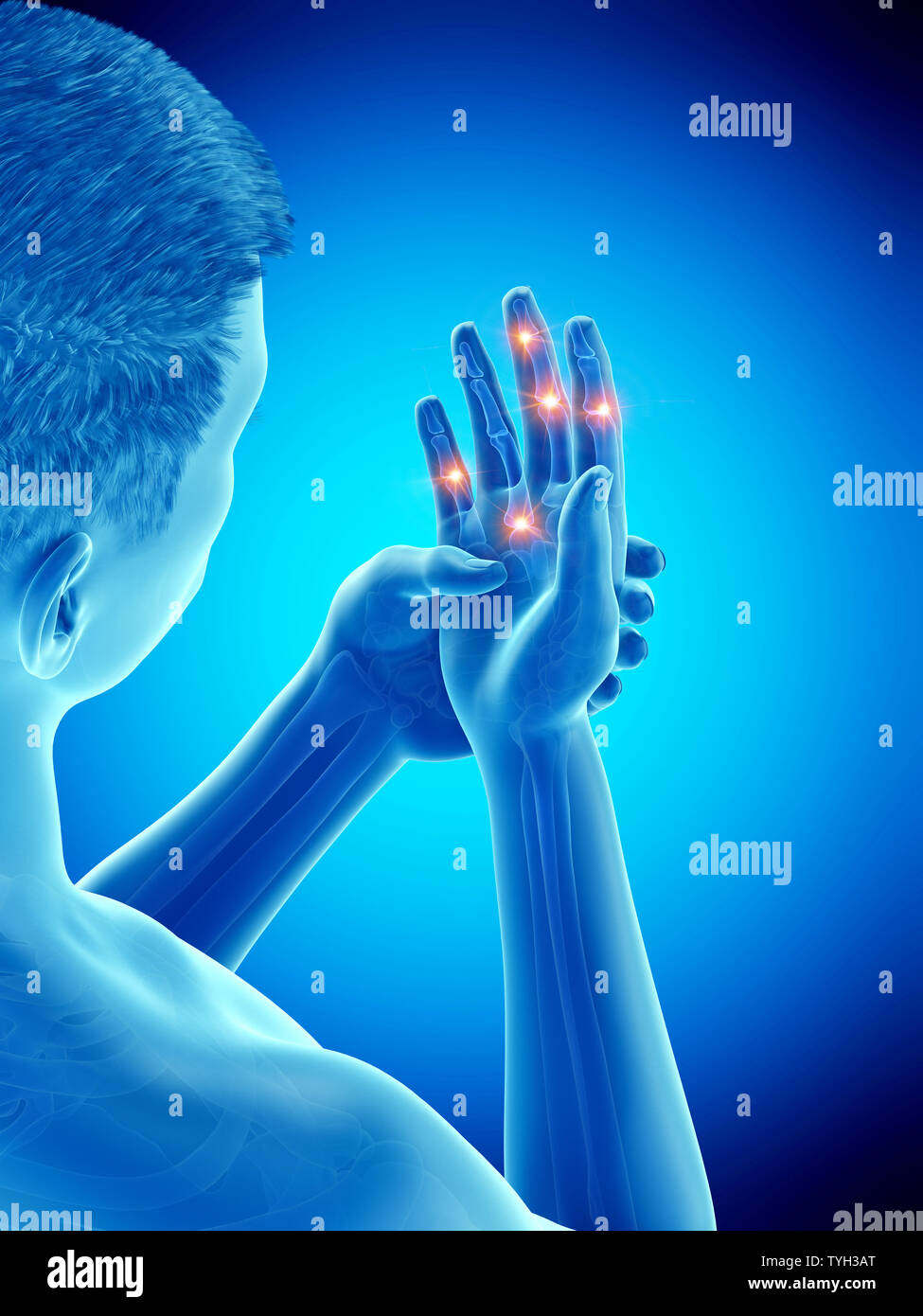 3d rendered medically accurate illustration of painful finger joints ...