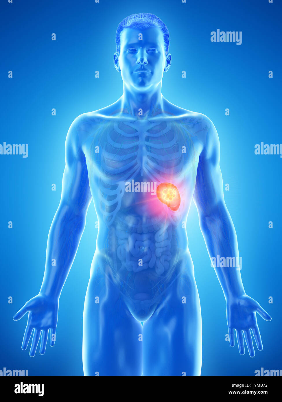 3d rendered medically accurate illustration of a mans spleen tumor ...