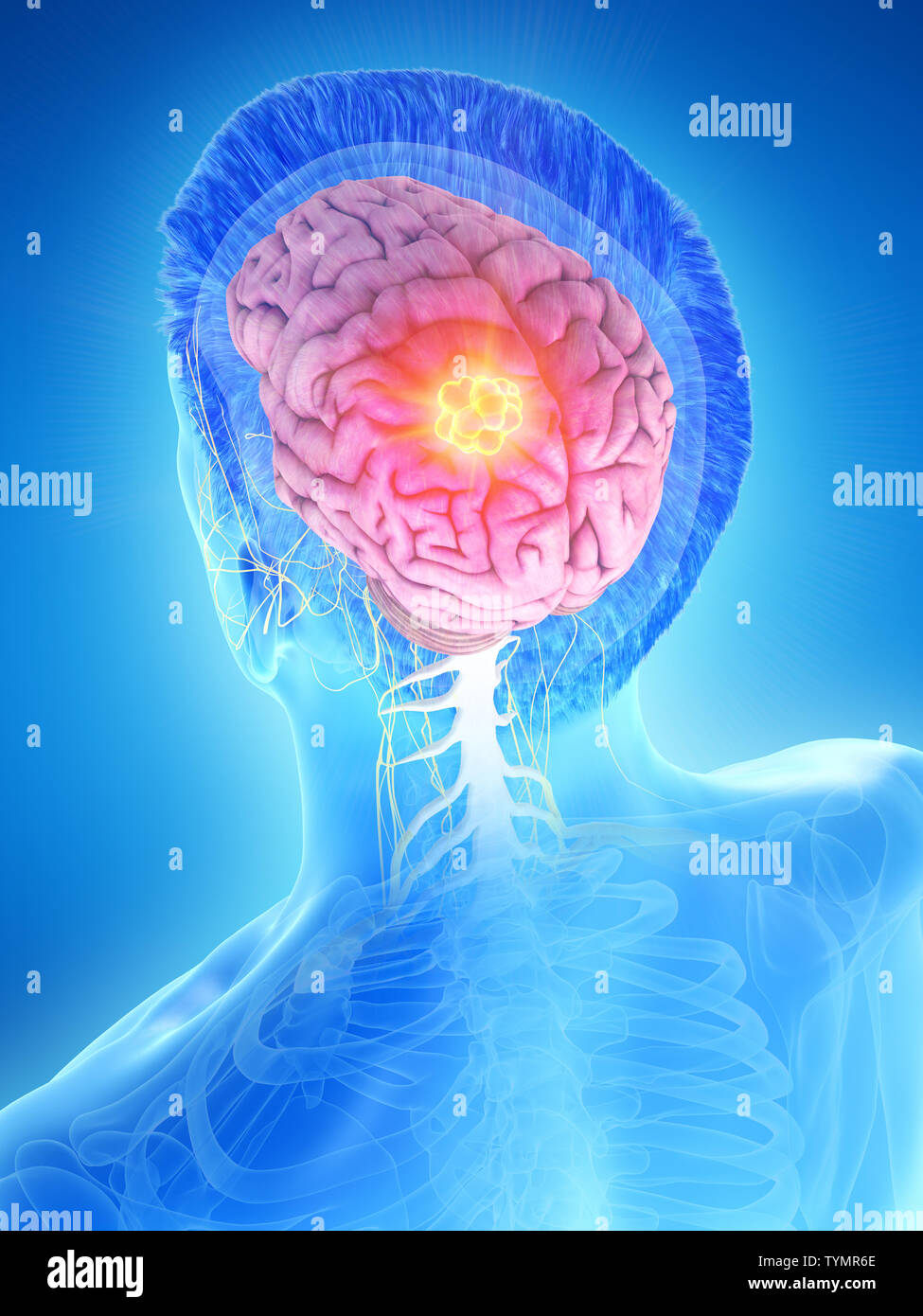 Inflamed brain hi-res stock photography and images - Alamy