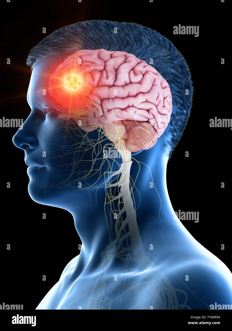 Inflamed brain hi-res stock photography and images - Alamy