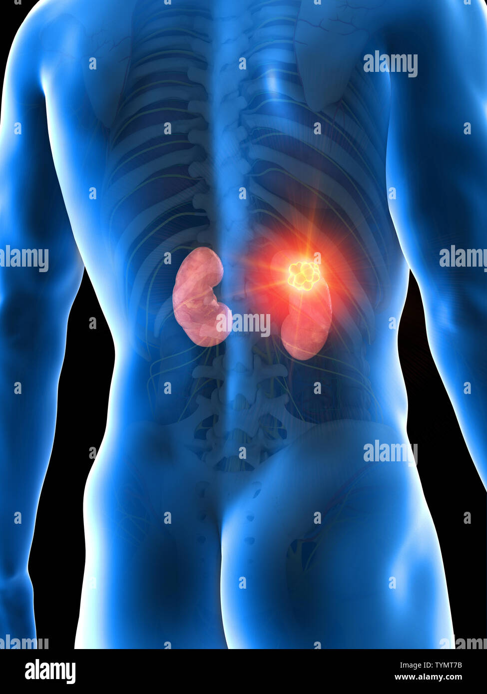 3d rendered medically accurate illustration of a mans kidney tumor ...