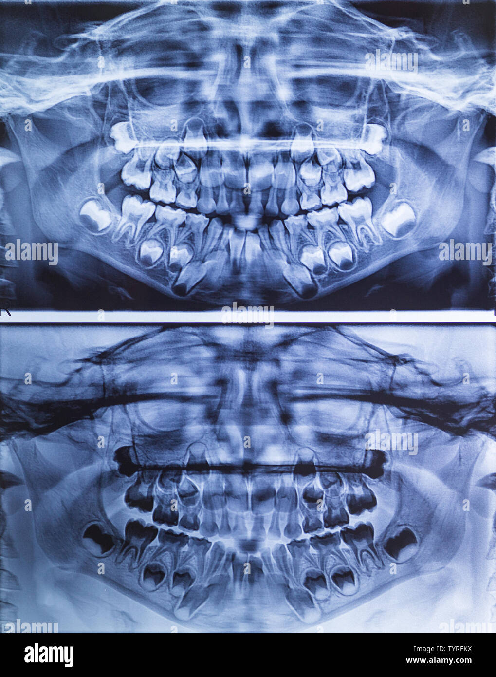Dental X-Ray panoramic of upper and lower jaw Stock Photo - Alamy