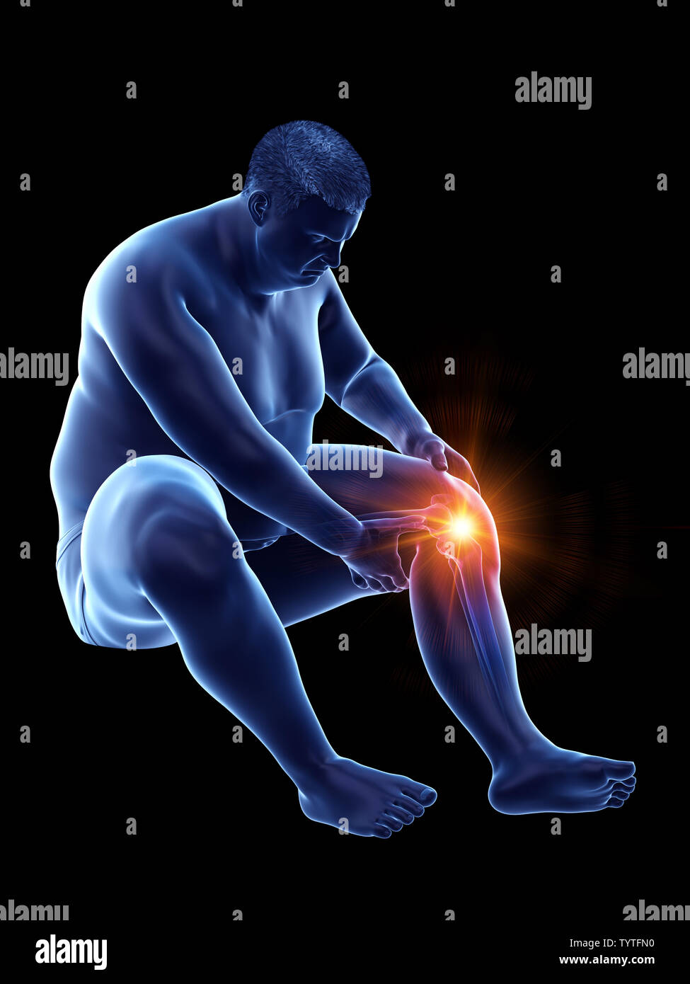 3d rendered medically accurate illustration of an obese mans painful ...
