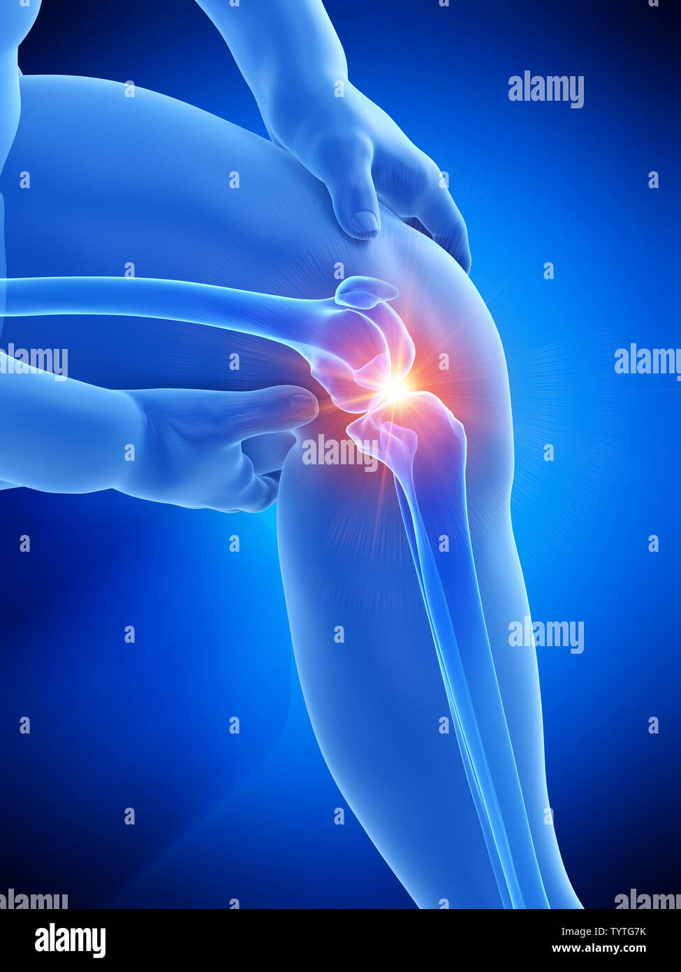 3d rendered medically accurate illustration of an obese mans painful ...