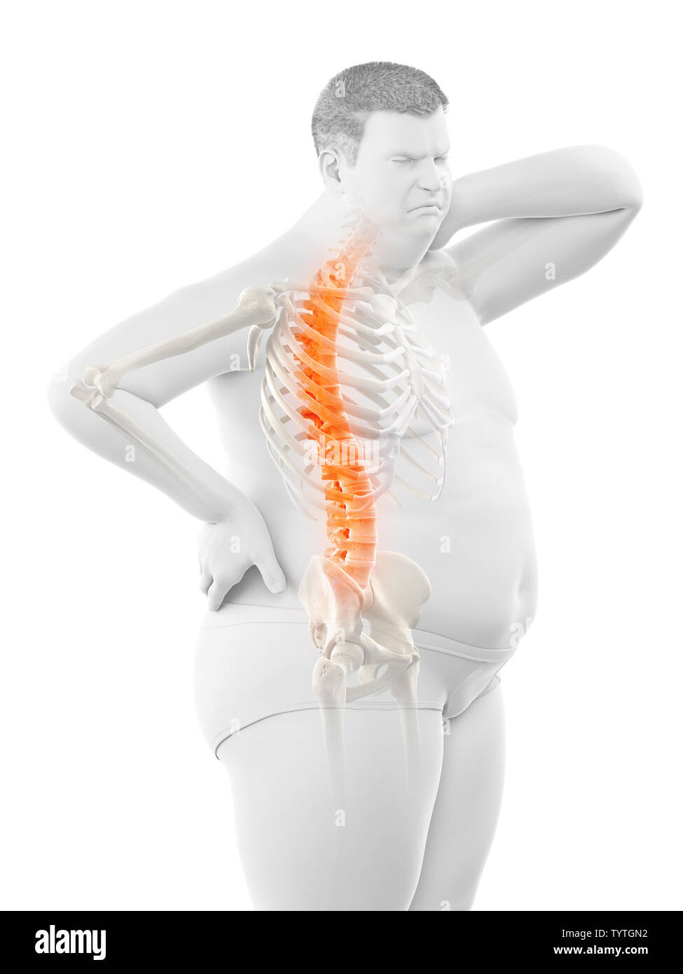 3d rendered medically accurate illustration of an obese mans painful ...