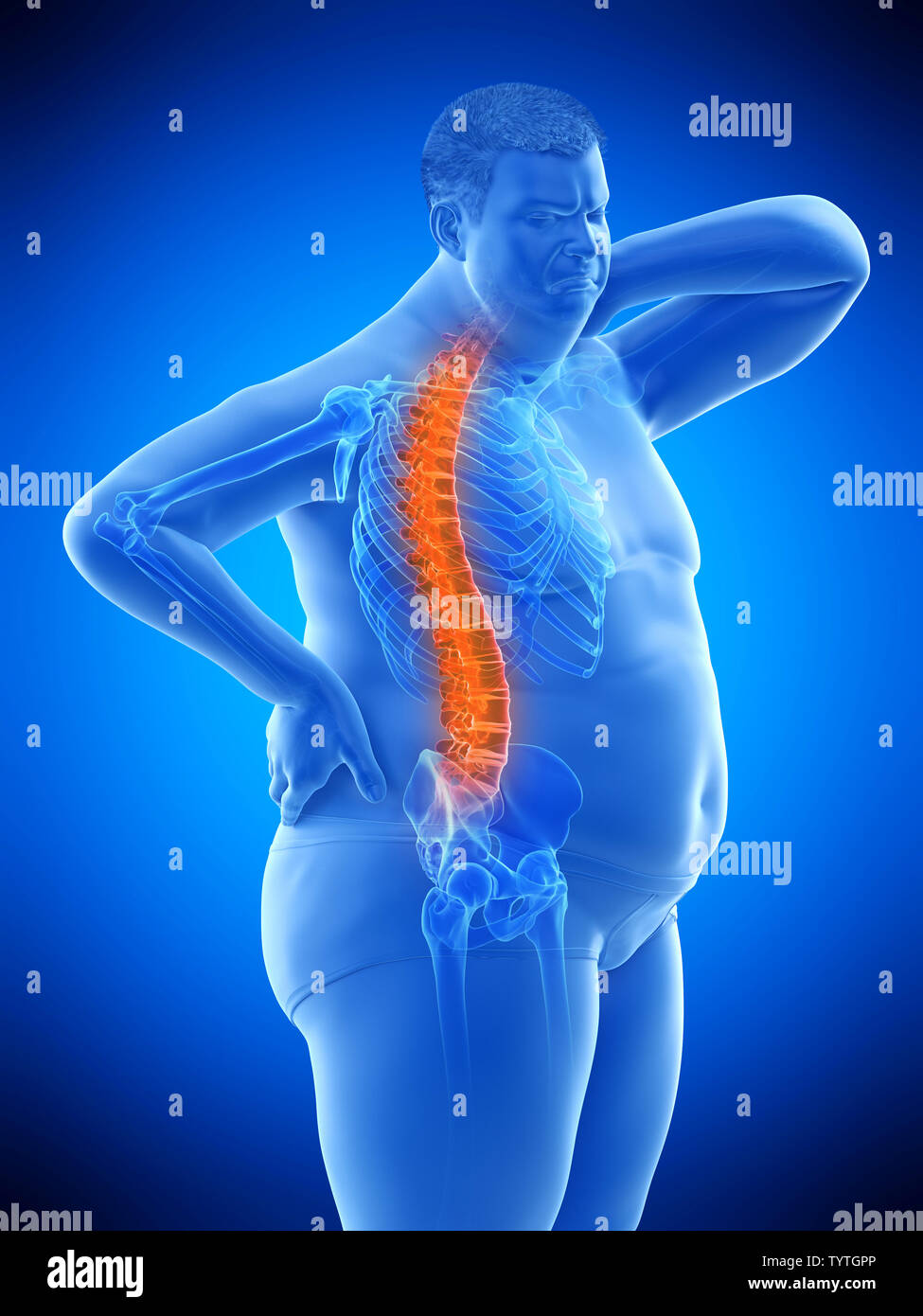 3d rendered medically accurate illustration of an obese mans painful ...