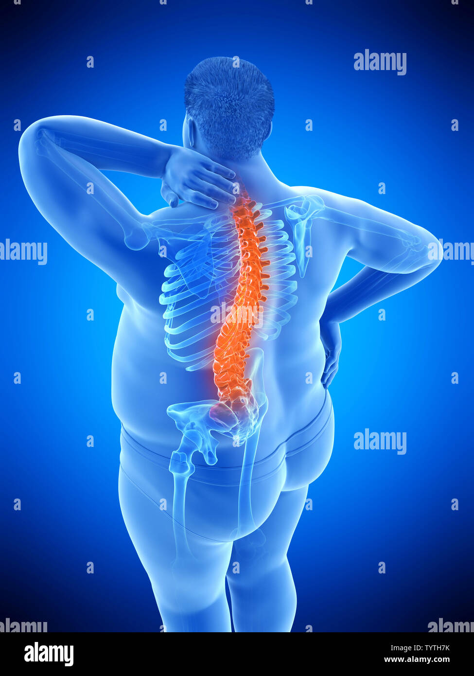 3d rendered medically accurate illustration of an obese mans painful ...
