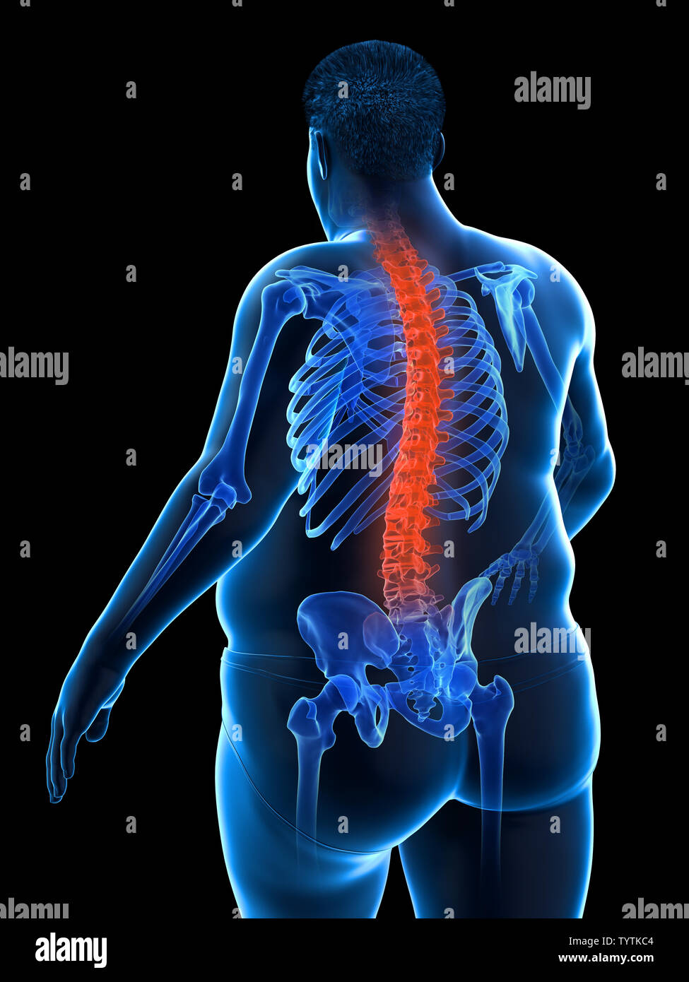 3d rendered medically accurate illustration of an obese mans painful ...