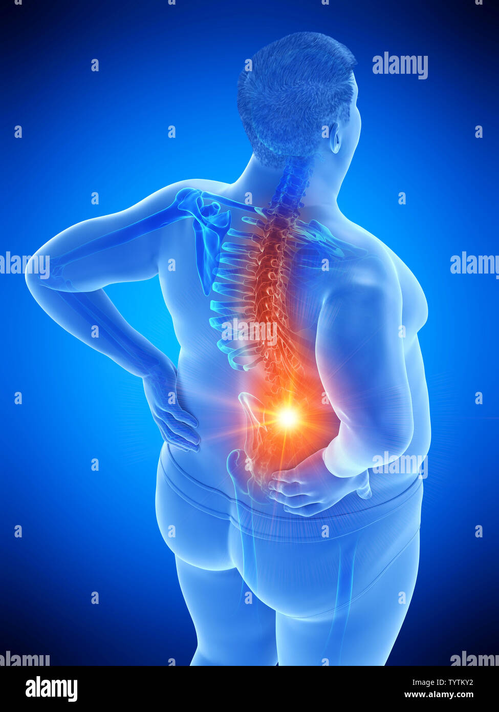 3d rendered medically accurate illustration of an obese mans painful ...