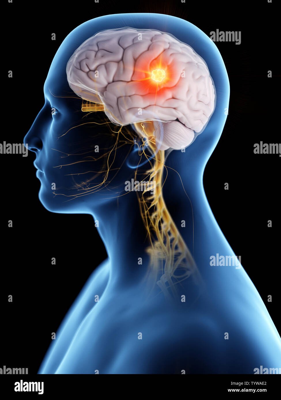 3d rendered medically accurate illustration of brain cancer Stock Photo ...