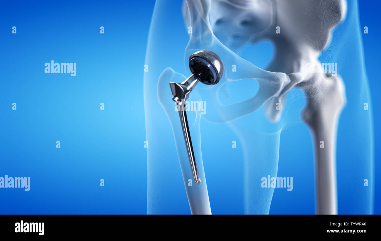 Hip replacement hi-res stock photography and images - Alamy