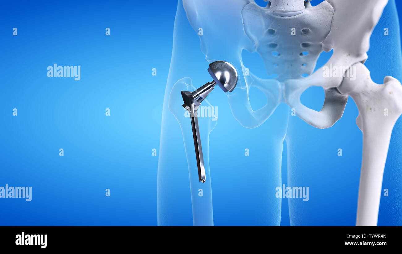 3d rendered medically accurate illustration of a hip replacement Stock ...