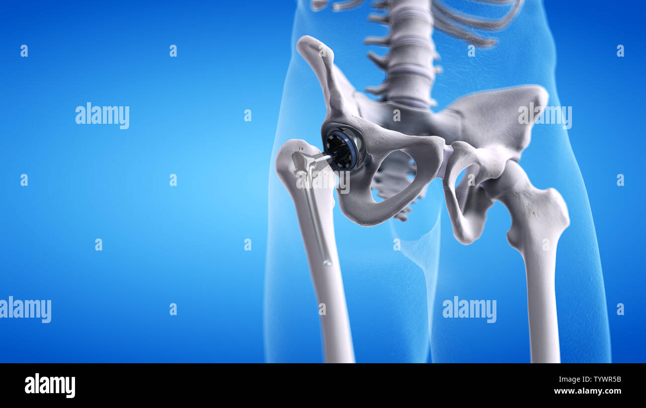 Metal on metal hip replacement hi-res stock photography and images - Alamy