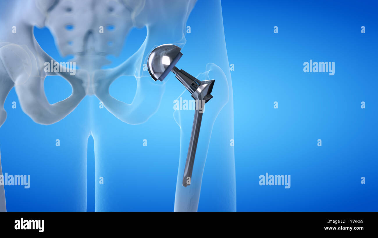 3d rendered medically accurate illustration of a hip replacement Stock ...