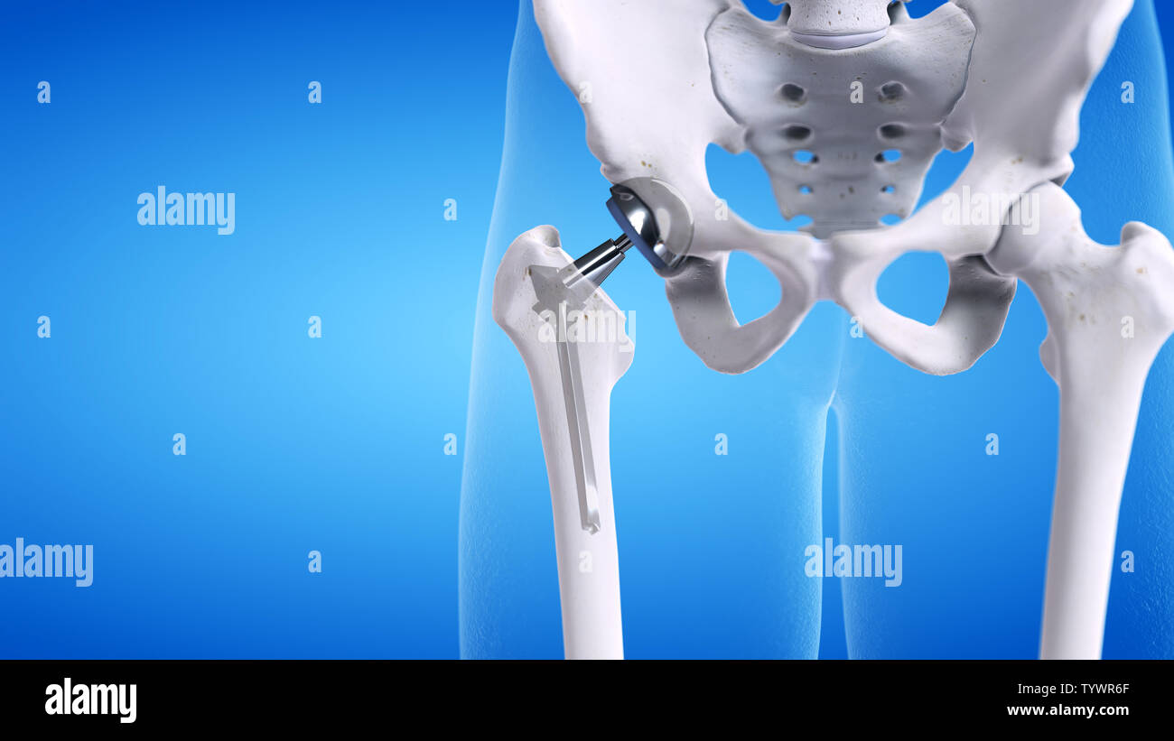 3d rendered medically accurate illustration of a hip replacement Stock ...