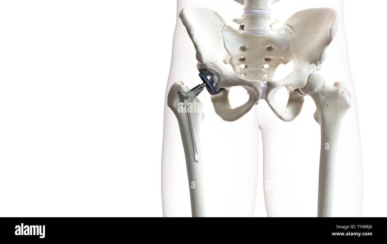 3d rendered medically accurate illustration of a hip replacement Stock ...