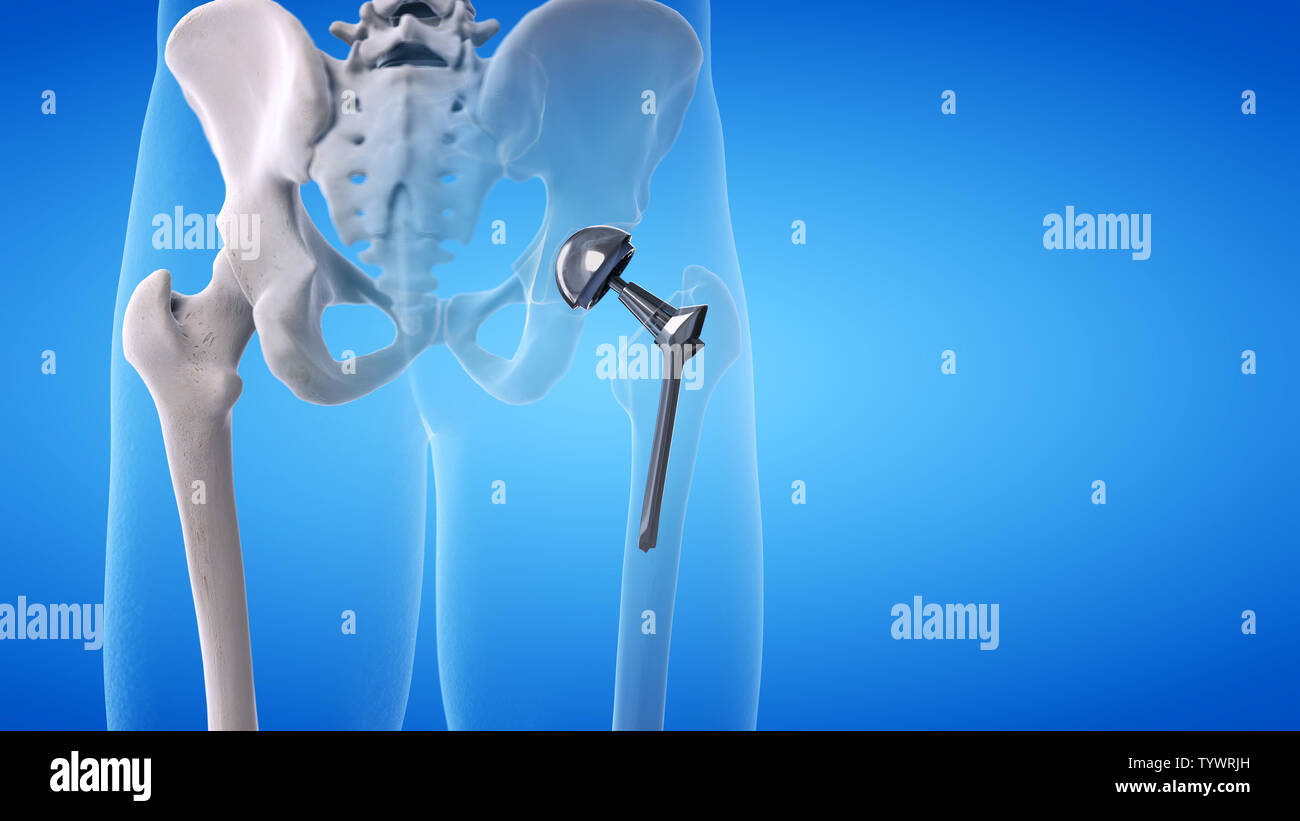 Metal on metal hip replacement hi-res stock photography and images - Alamy