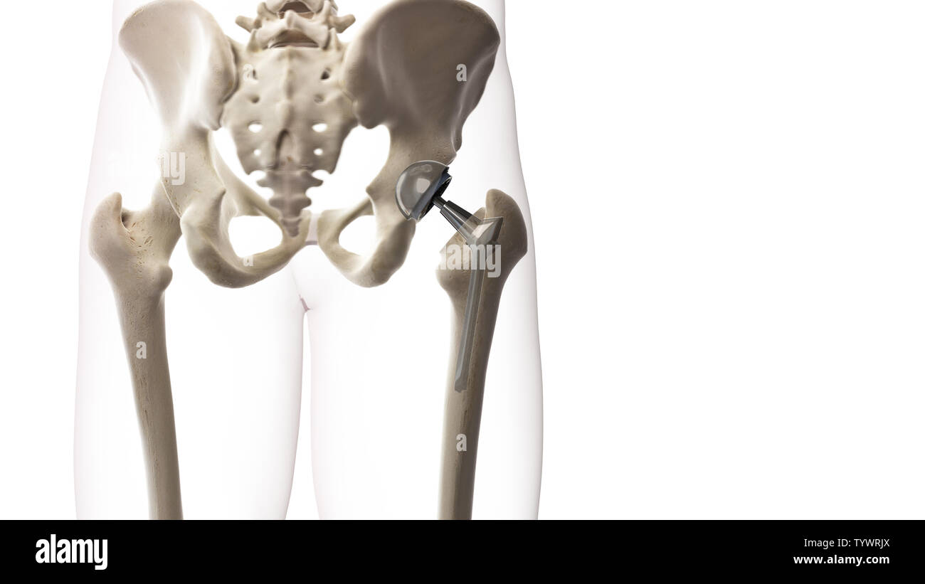 3d rendered medically accurate illustration of a hip replacement Stock ...