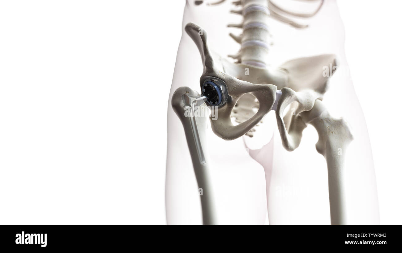 3d rendered medically accurate illustration of a hip replacement Stock ...