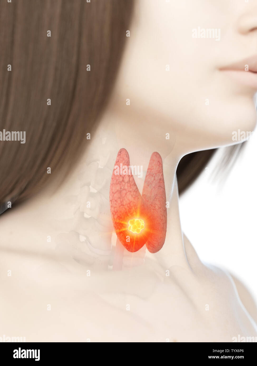 Goiter woman hi-res stock photography and images - Alamy