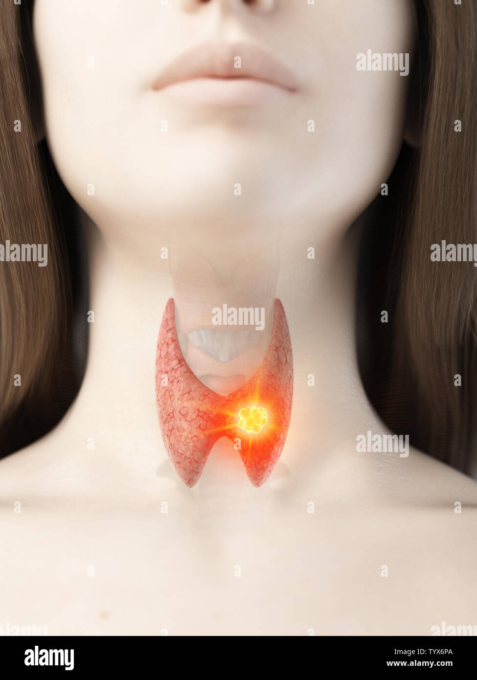 Goiter woman hi-res stock photography and images - Alamy
