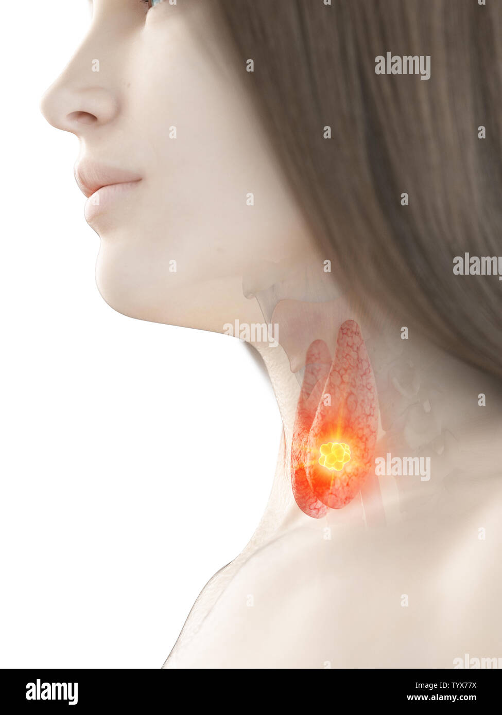 Goiter woman hi-res stock photography and images - Alamy