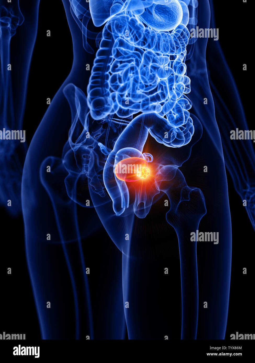 3d rendered medically accurate illustration of a womans bladder tumor ...
