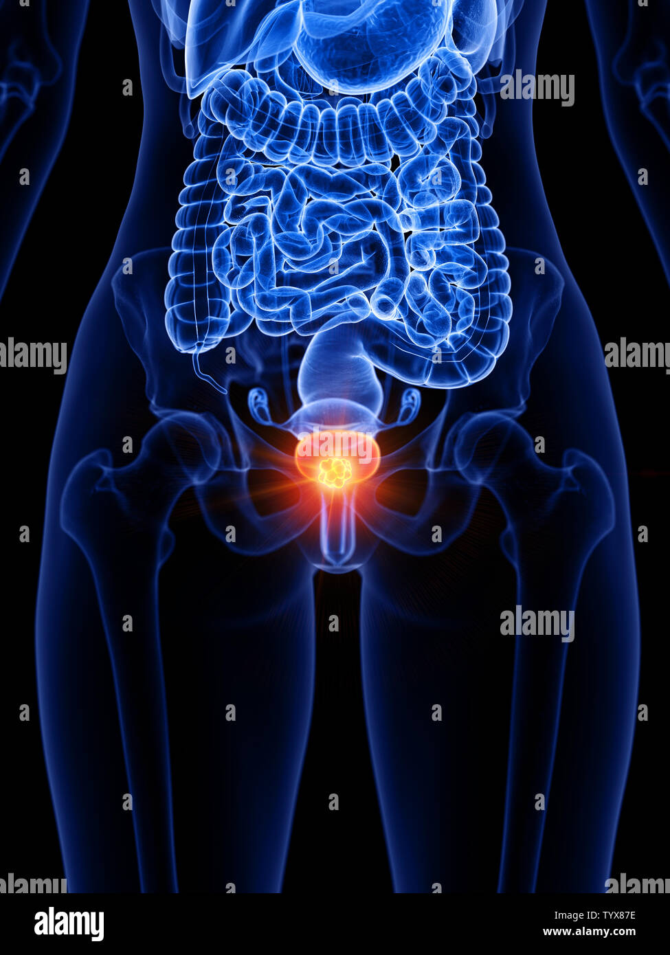 3d rendered medically accurate illustration of a womans bladder tumor ...