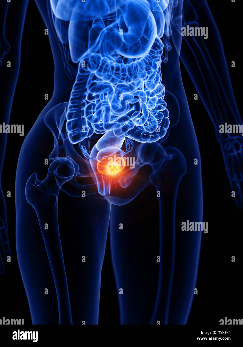 3d rendered medically accurate illustration of a womans bladder tumor ...