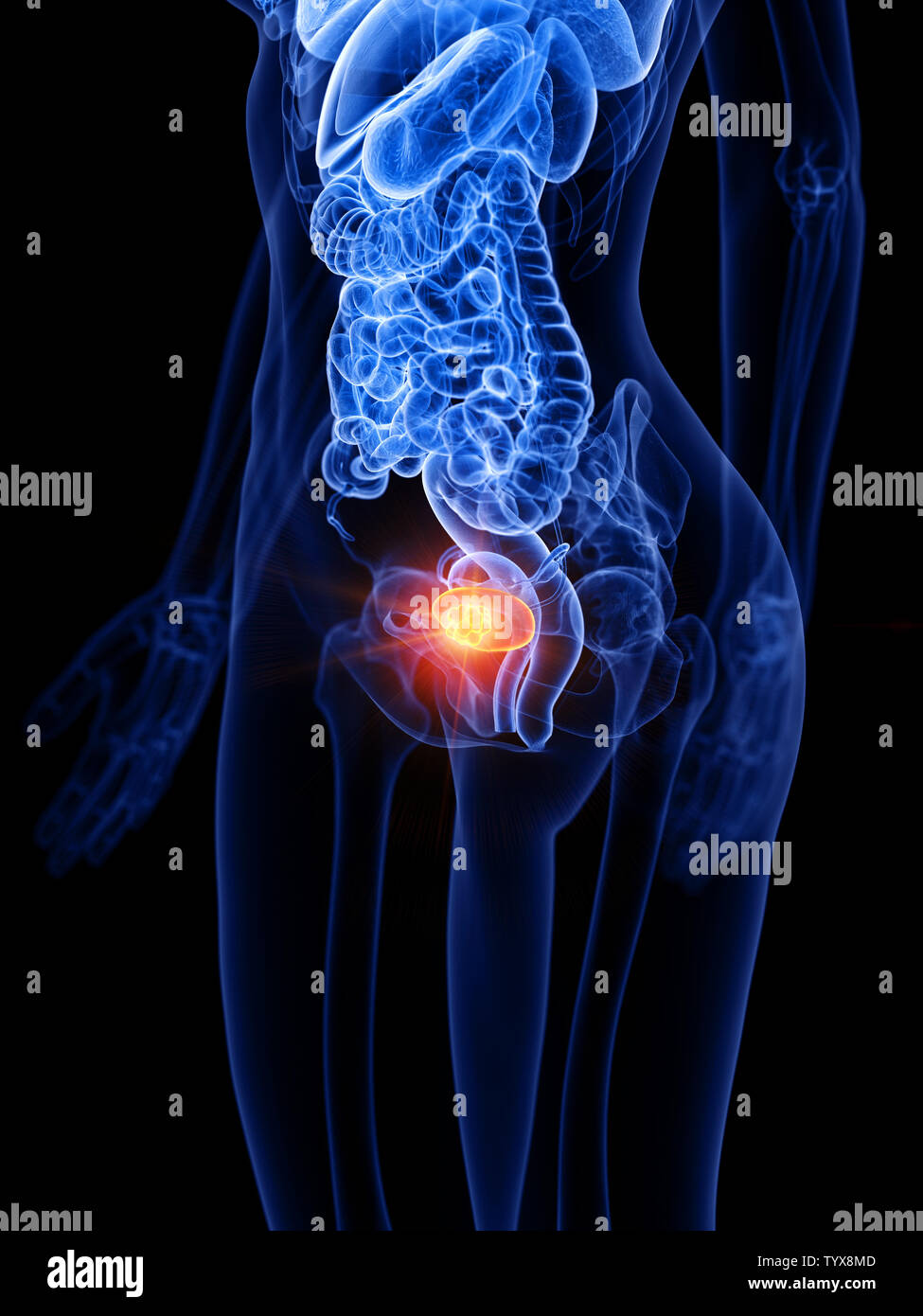 3d rendered medically accurate illustration of a womans bladder tumor ...