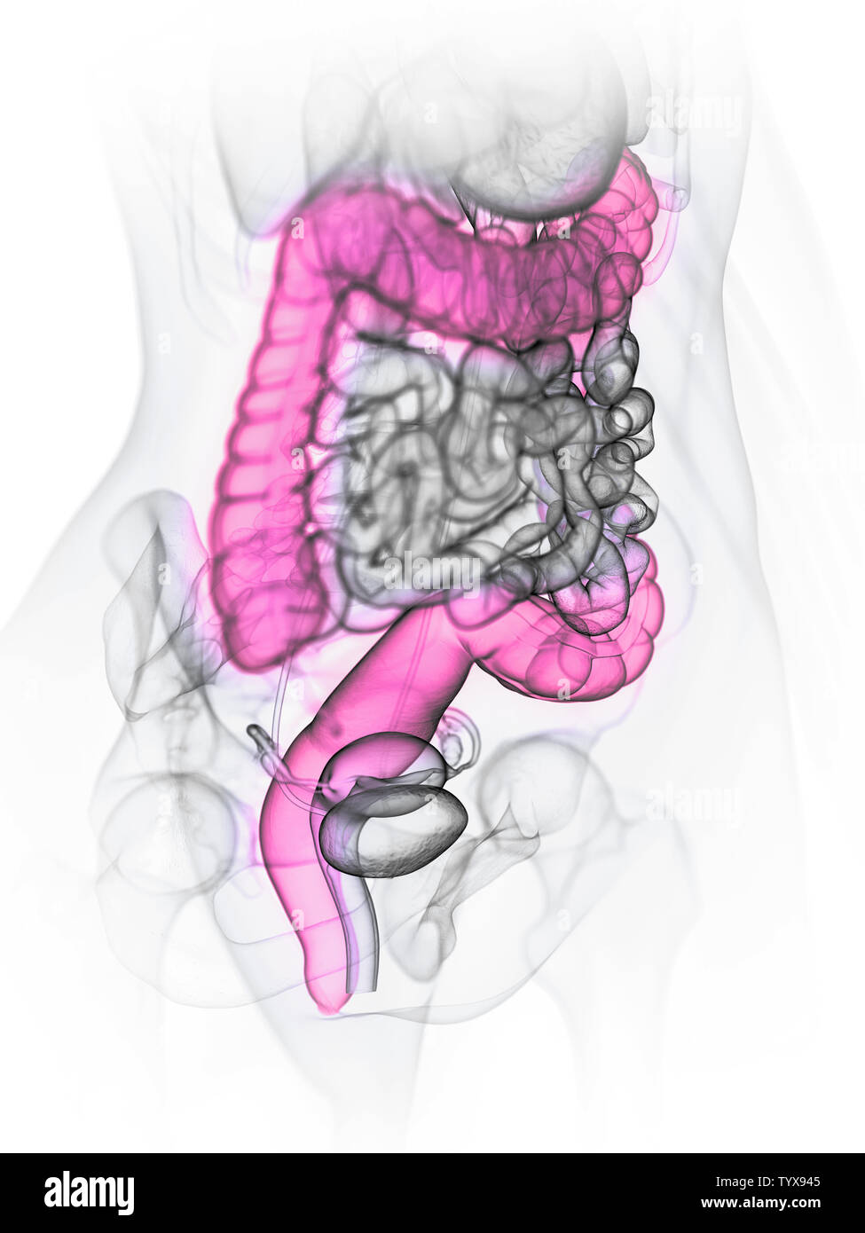 Diverticulitis of colon Cut Out Stock Images & Pictures - Alamy