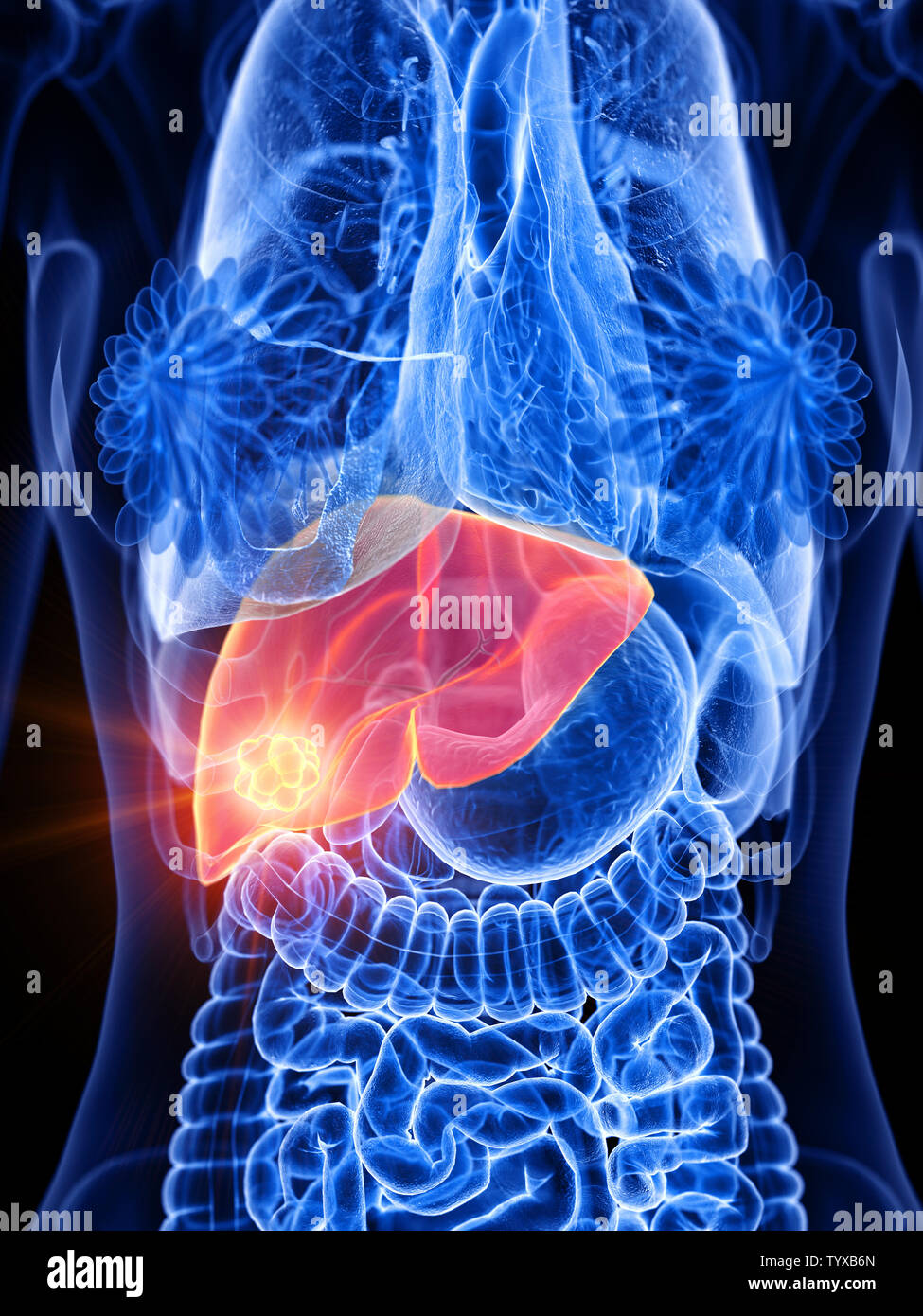 Liver tumor hi-res stock photography and images - Alamy