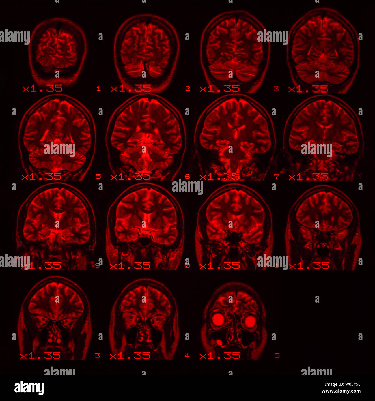 MRI of the brain on a black background with red backlight. Square photo ...