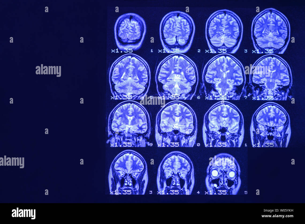 Left brain mri hi-res stock photography and images - Alamy