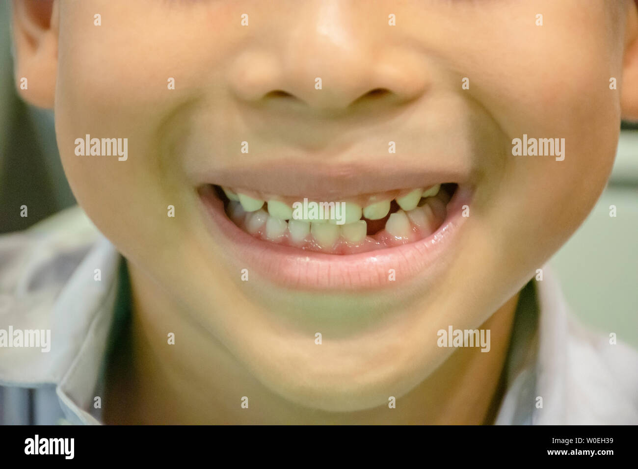 Baby teeth loss hi-res stock photography and images - Alamy