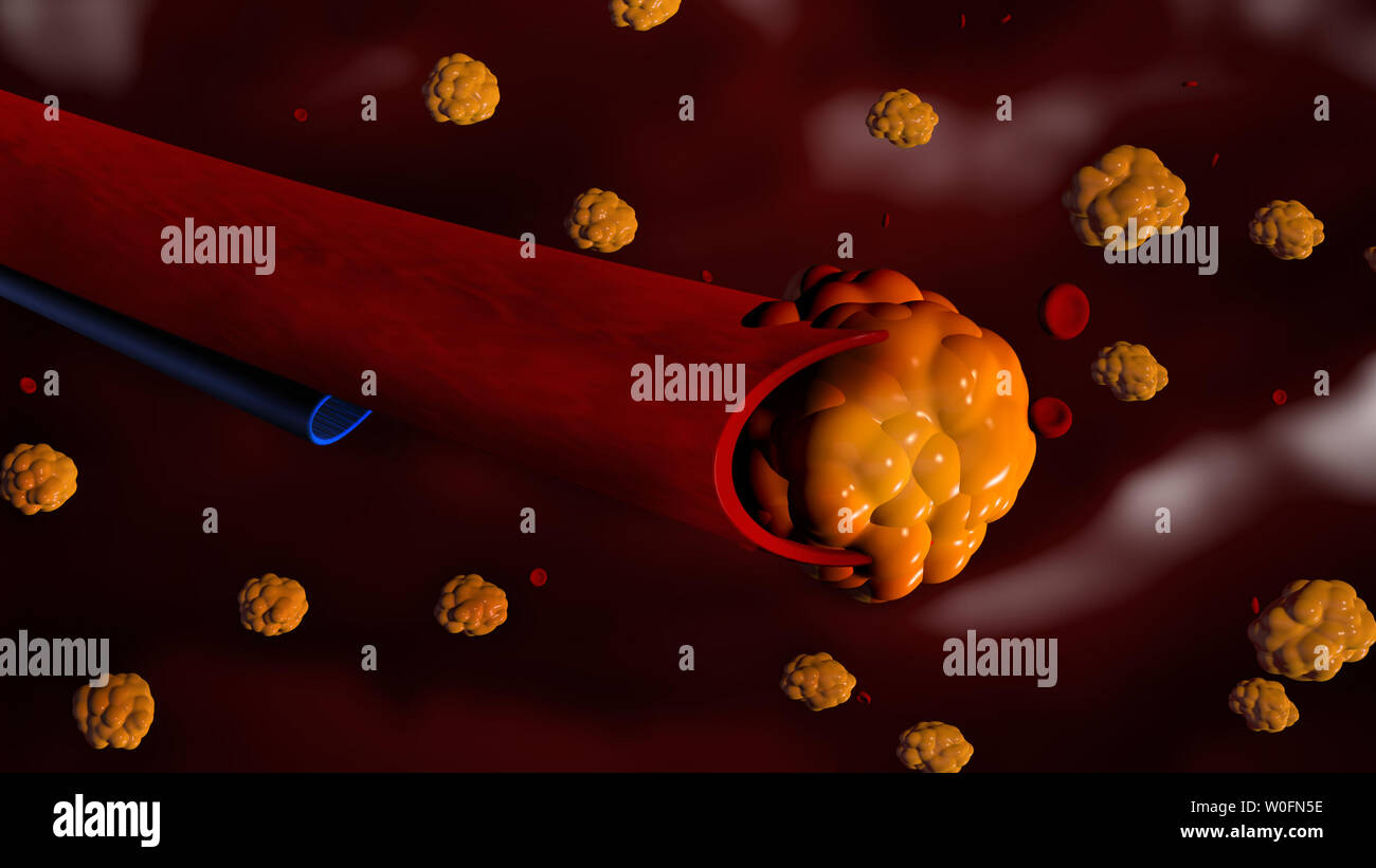 Cholesterol and artery graphic heart attack Stock Photo - Alamy