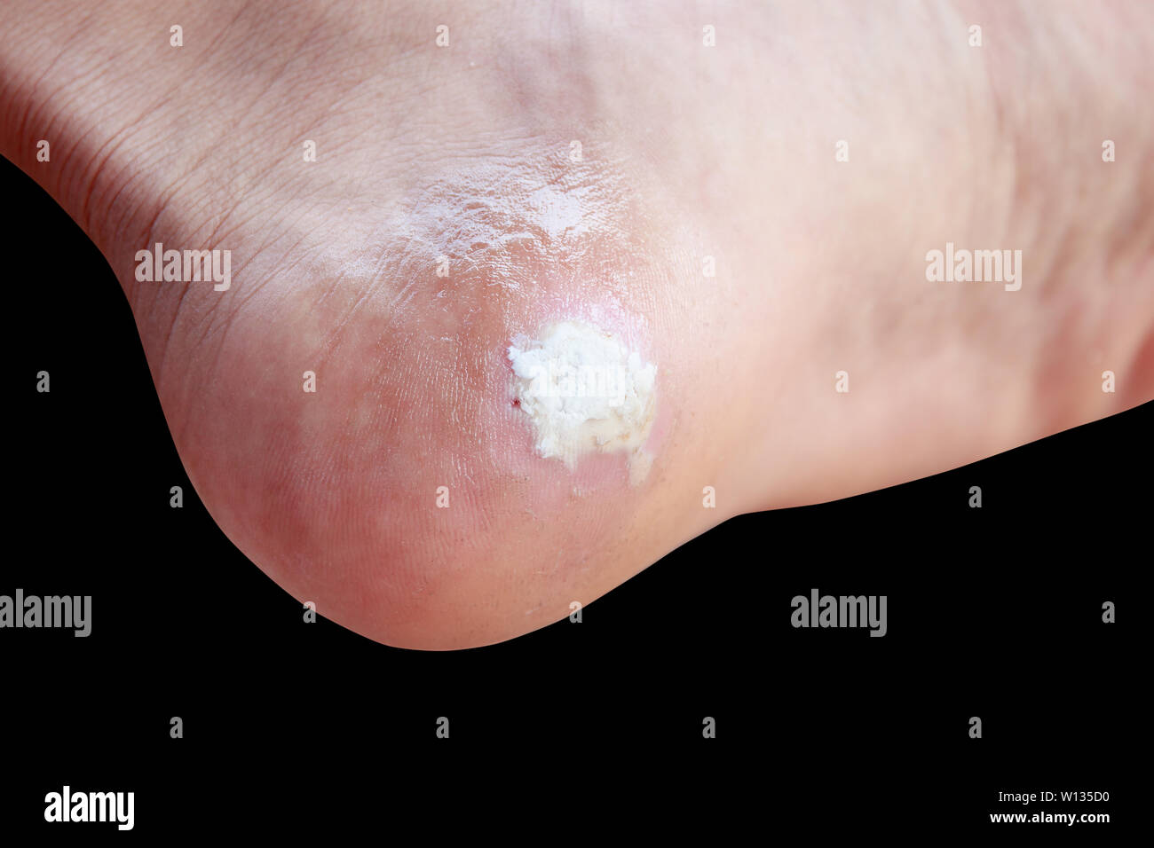 close up pain foot corn isolated on black background with clipping path ...