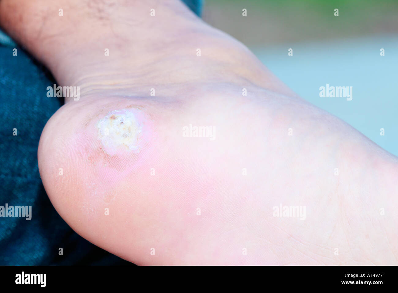 close up pain foot corn isolated on black background with clipping path ...