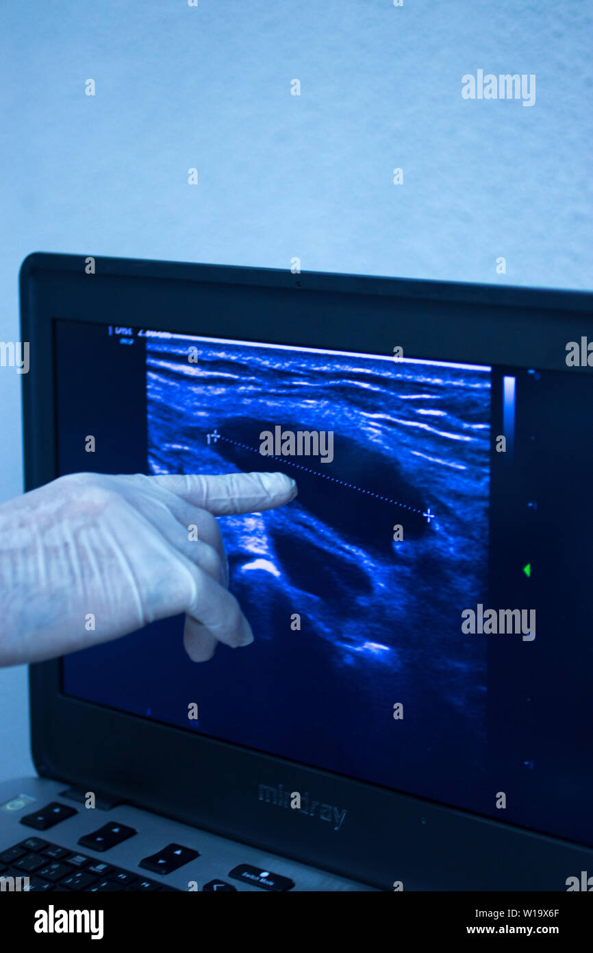 EPI Intratissue Percutaneous Electrolysis dry needling ultrasound ecography scan physiotherapy ...