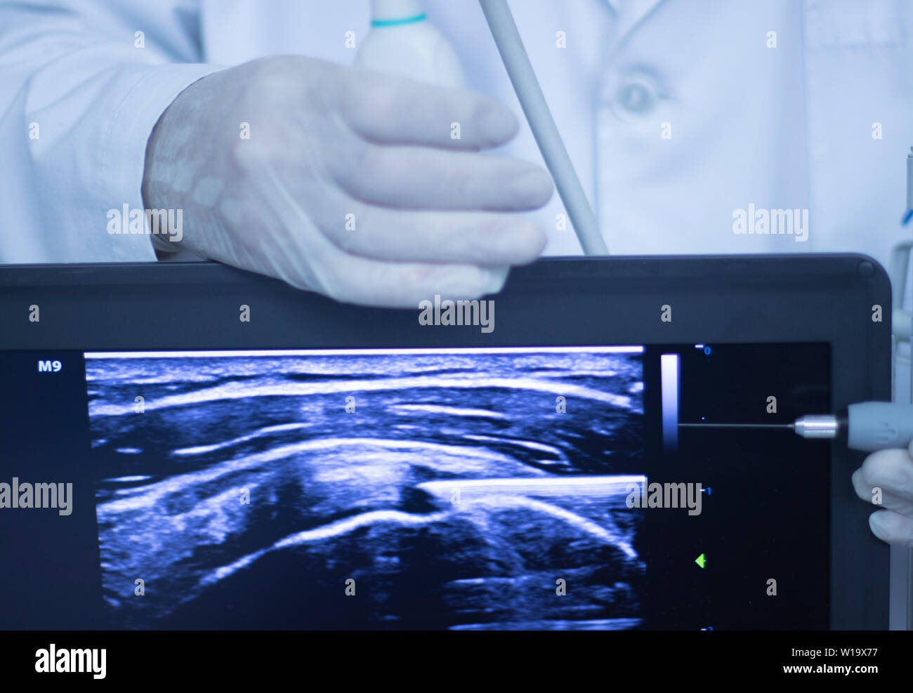 EPI Intratissue Percutaneous Electrolysis dry needling ultrasound ecography scan physiotherapy ...