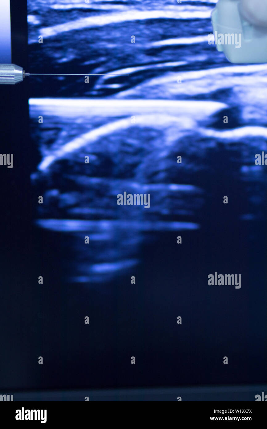 EPI Intratissue Percutaneous Electrolysis dry needling ultrasound ...