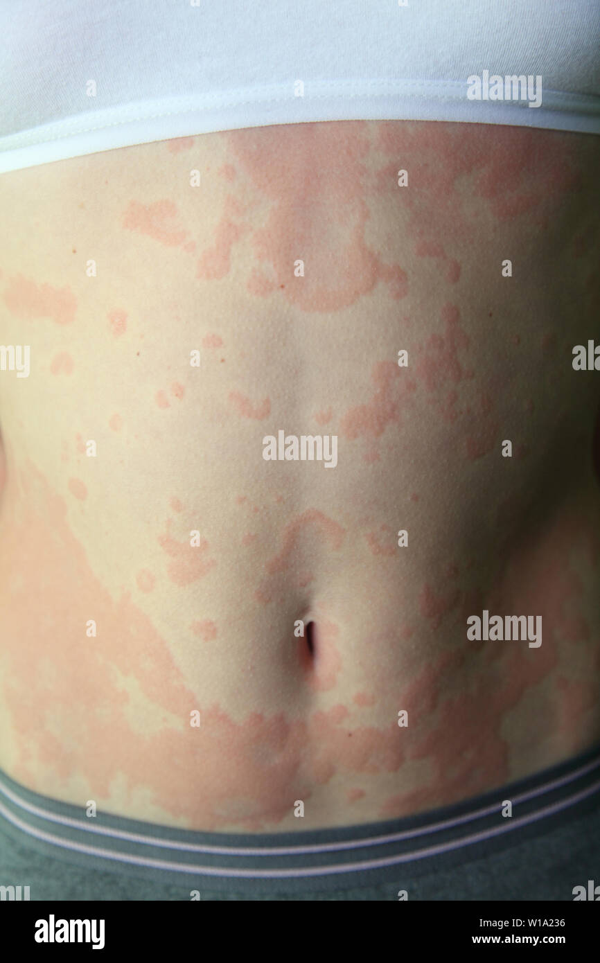 allergic dermatitis. The skin of the girl is amazed by dermatitis Stock ...